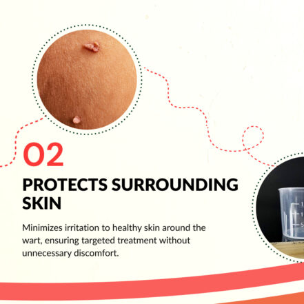 Buy Soluver Plus Warts Treatment [27 % Salicylic Acid]